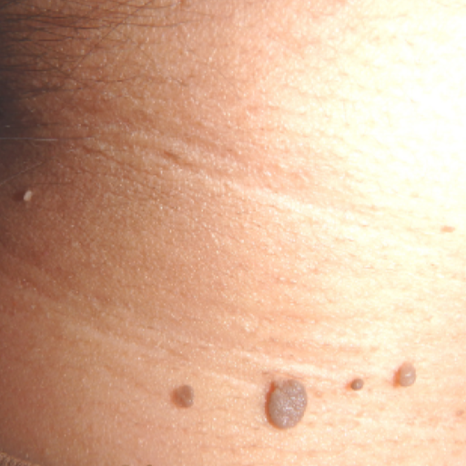 Skin Tag Removal Ottawa - Skin Tag Removal Ottawa